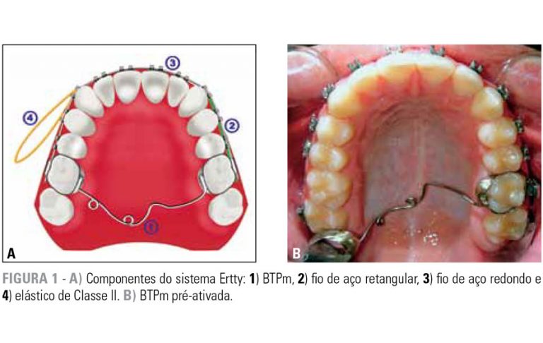 Sistema Ertty para Distalização de Molares: Entenda Mais Sobre o Sistema