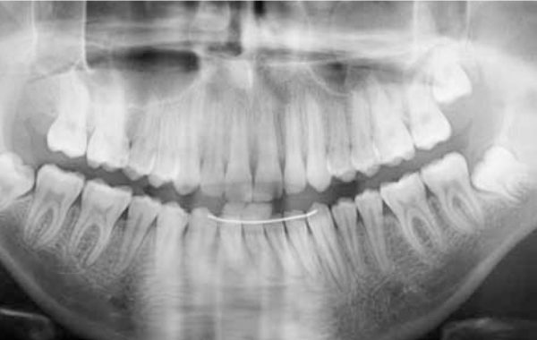 Sistema Ertty para Distalização de Molares: Entenda Mais Sobre o Sistema